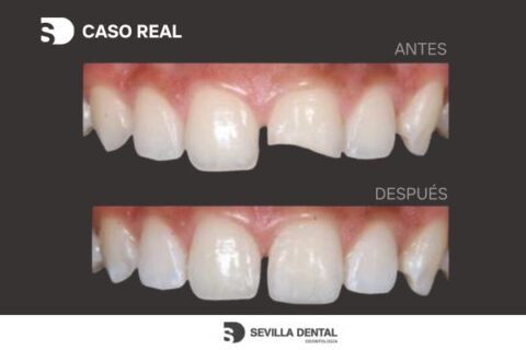 Reconstrucción Dental: Qué es, Tipos y Precios | Sevilla Dental
